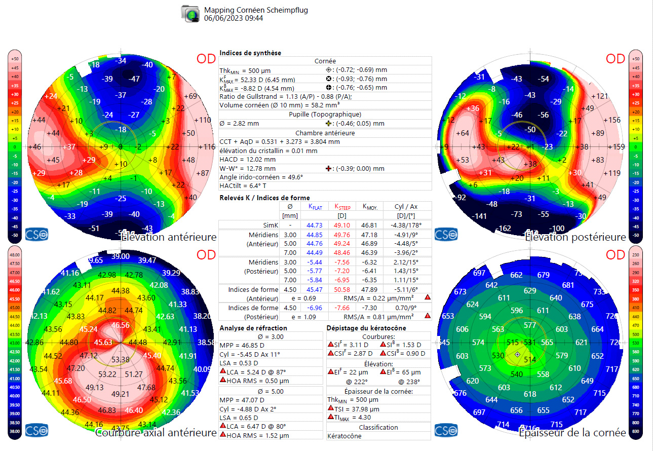 Topographie Cornéenne | Ma vision